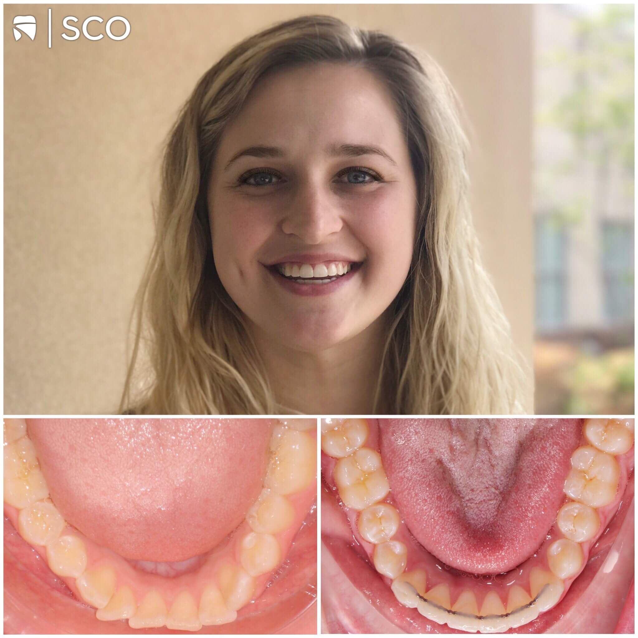 Before And Afters Saddle Creek Orthodontics Germantown Braces