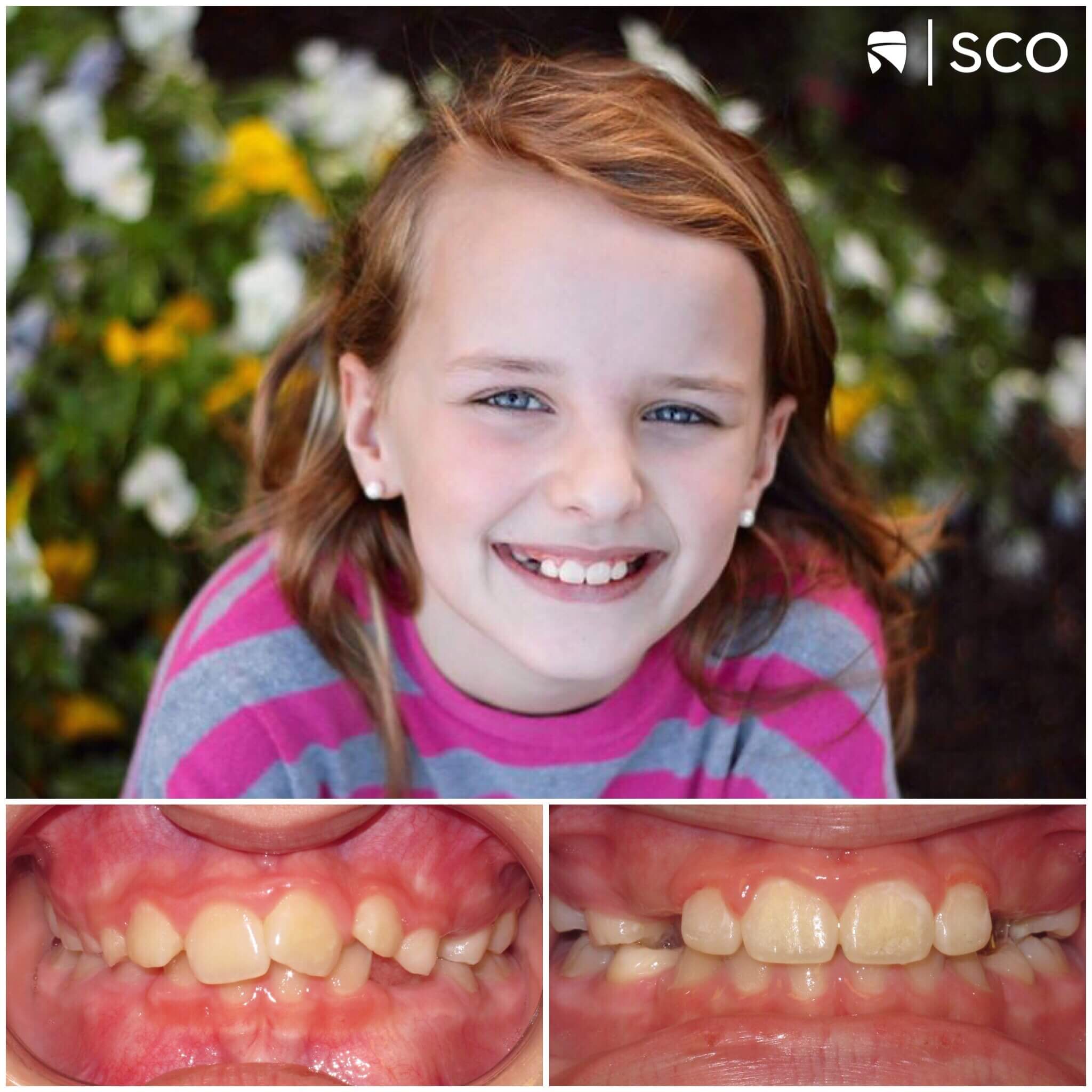 Before And Afters Saddle Creek Orthodontics Germantown Braces