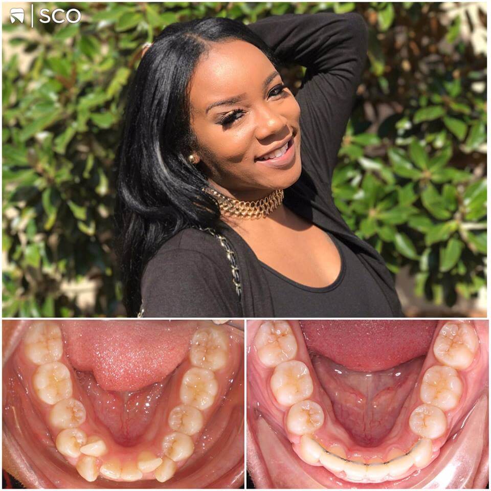 Before And Afters Saddle Creek Orthodontics Germantown Braces