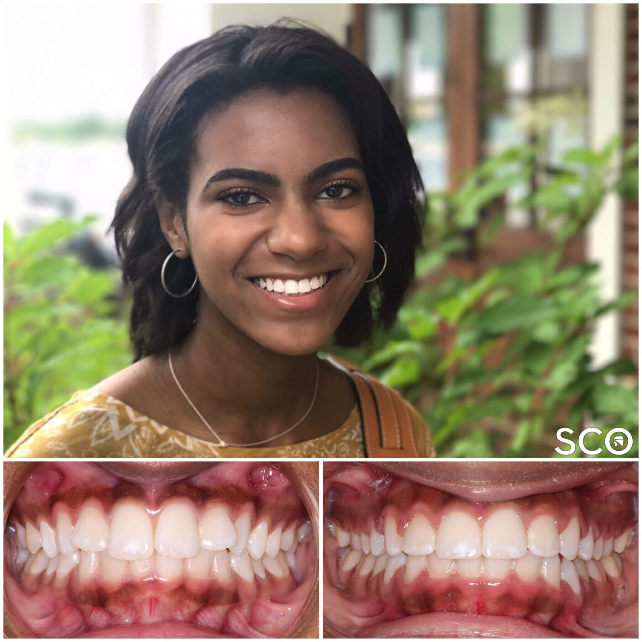 Before And Afters Saddle Creek Orthodontics Germantown Braces