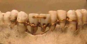 The History Of Braces | Memphis Braces | Saddle Creek Orthodontics