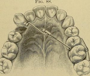 The History Of Braces | Memphis Braces | Saddle Creek Orthodontics