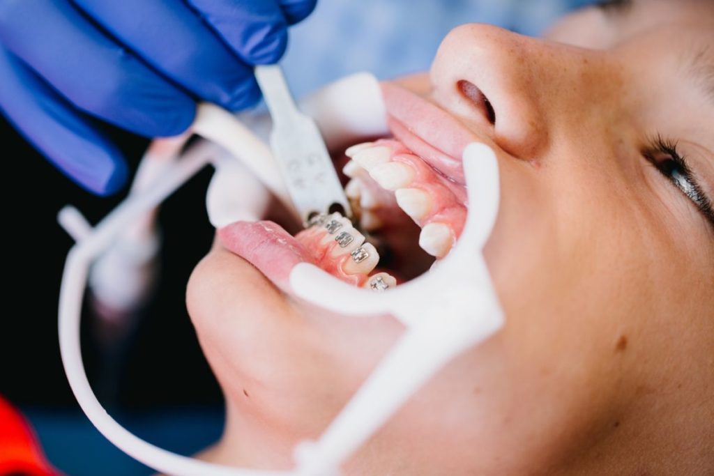 Let’s Get Technical: How Do Braces Move Teeth | Saddle Creek