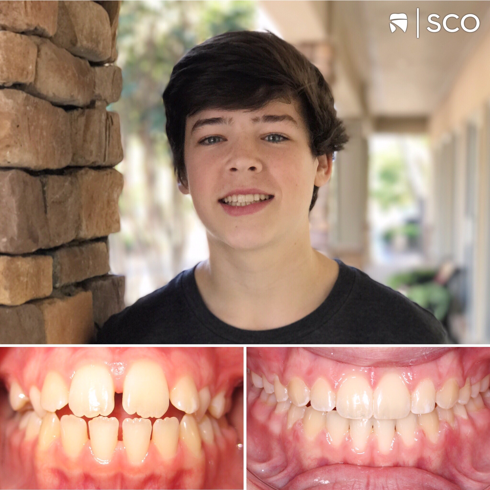 What Orthodontic Issues Can Braces Treat? | Saddle Creek Orthodontics